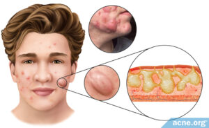 What Is a Draining Sinus? - Acne.org