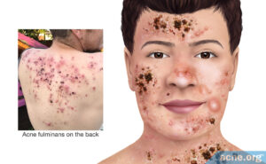 What Is Acne Fulminans? - Acne.org