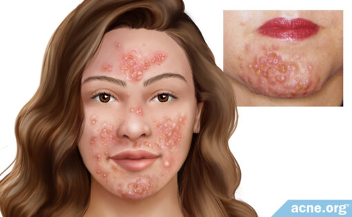 What Is Pyoderma Faciale? - Acne.org