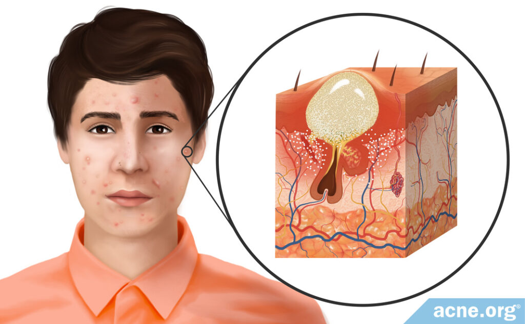 What Is Acne - An In-depth Look - Acne.org