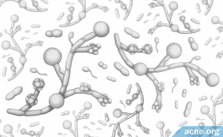 What is Acne Archives - Acne.org