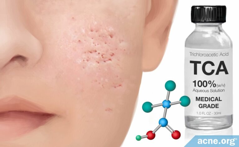How Trichloroacetic Acid (TCA) Reduces Acne Scars (and May Also Help ...