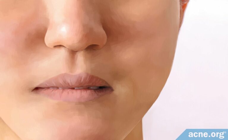 What is Acne Archives - Acne.org