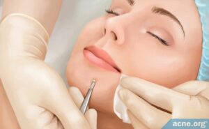 What Is Comedone Extraction, and Should You Do It? - Acne.org