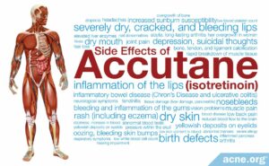 What are the side effects of Accutane (isotretinoin)? - Acne.org