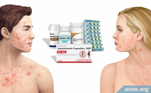 Whats The Best Treatment For Cystic Acne