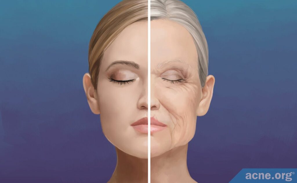 What is Acne Archives - Acne.org