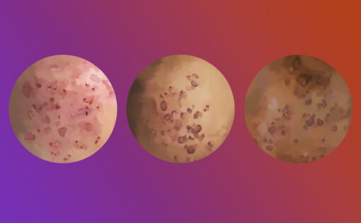 Why Acne Scars Are Red/Purple - Acne.org