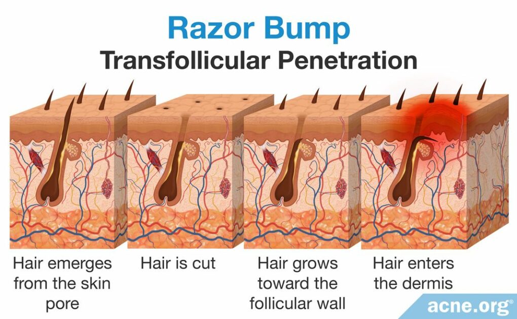What Are Razor Bumps? - Acne.org