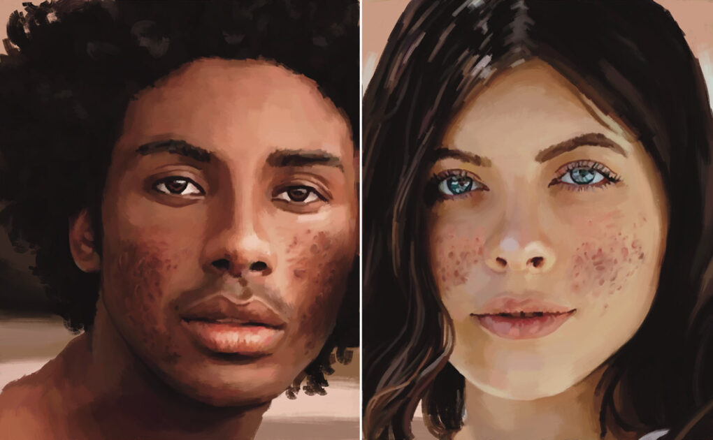 Why Acne Scars Are Red/Purple - Acne.org