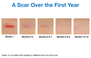Do Acne Scars Fade with Time? - Acne.org