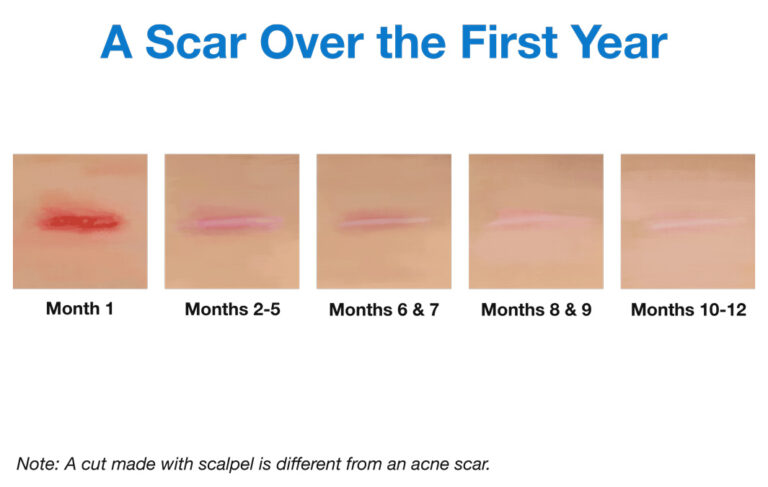 Do Acne Scars Fade with Time? - Acne.org