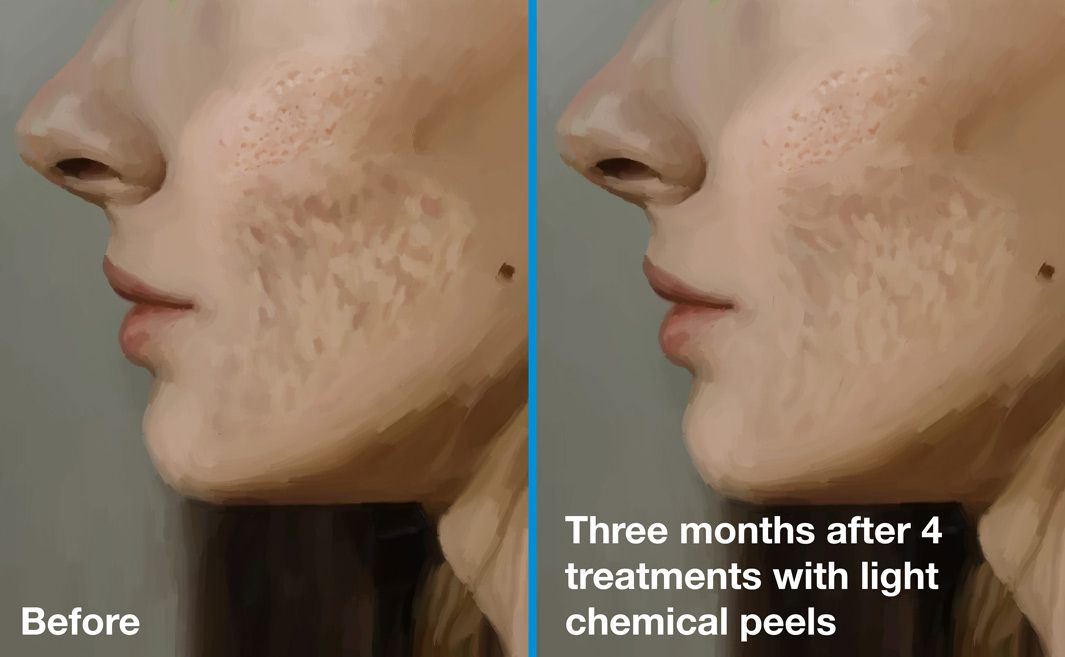 About - Acne.org