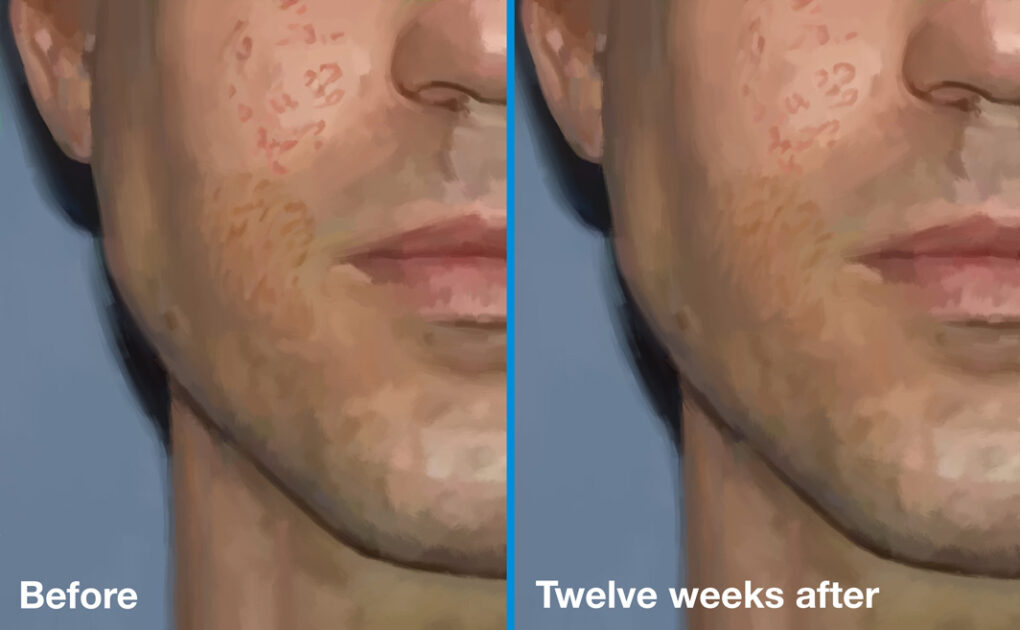 About - Acne.org