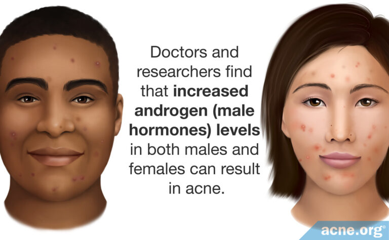 Hormones and Acne: Causes and Solutions Explained - Acne.org