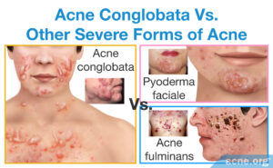 What Is Acne Conglobata? - Acne.org