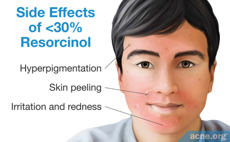 Resorcinol - Everything You Need to Know - Acne.org
