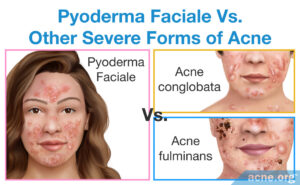 What Is Pyoderma Faciale? - Acne.org
