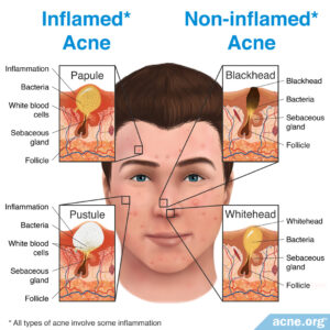 What Is the Difference Between Inflamed and Non-inflamed Acne? - Acne.org