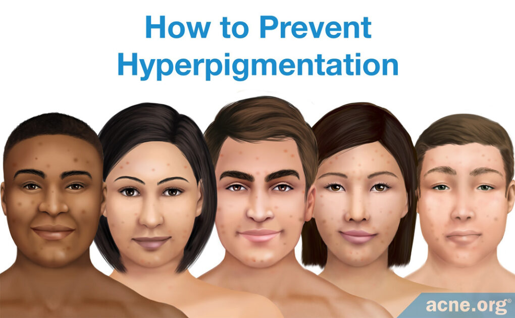 Handling Hyperpigmentation - Acne.org