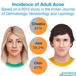 Adult Acne: Understanding the Causes and Effects - Acne.org