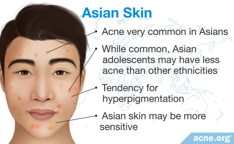 Asian Skin and Acne - Acne.org