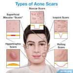 What Causes a Pimple to Scar? - Acne.org