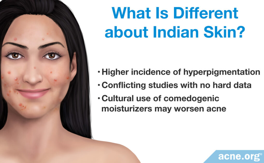 Acne on Indian Skin: Causes & Treatments | Acne.org