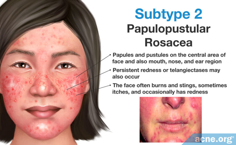 Rosacea - Acne.org