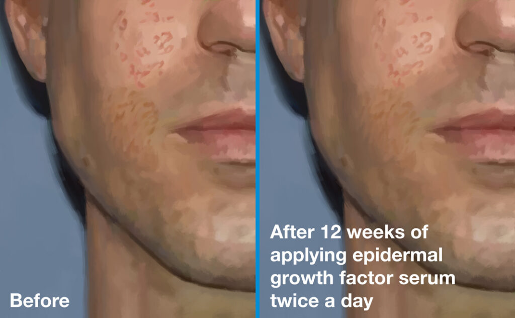 About - Acne.org